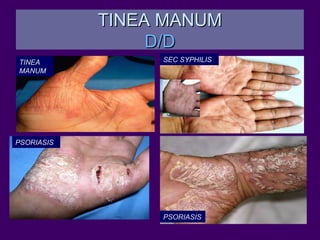 fungal infection and their treatment.ppt