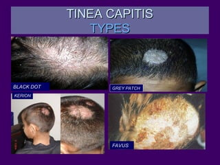 fungal infection and their treatment.ppt