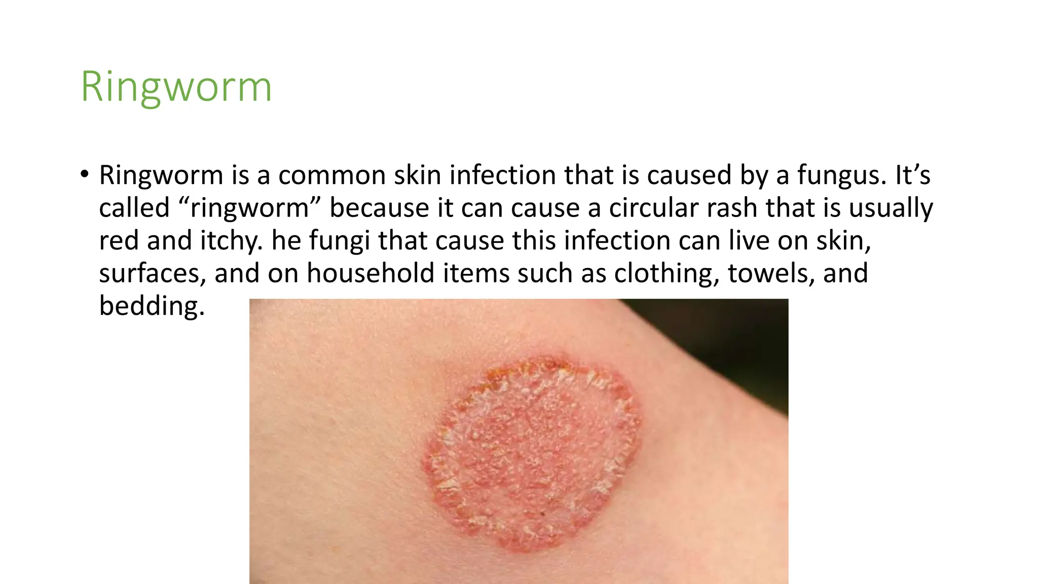 Fungal Infection (pharmacology and rehab) | PPTX