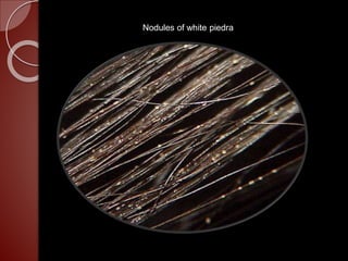 Fungal infection in hair | PPTX