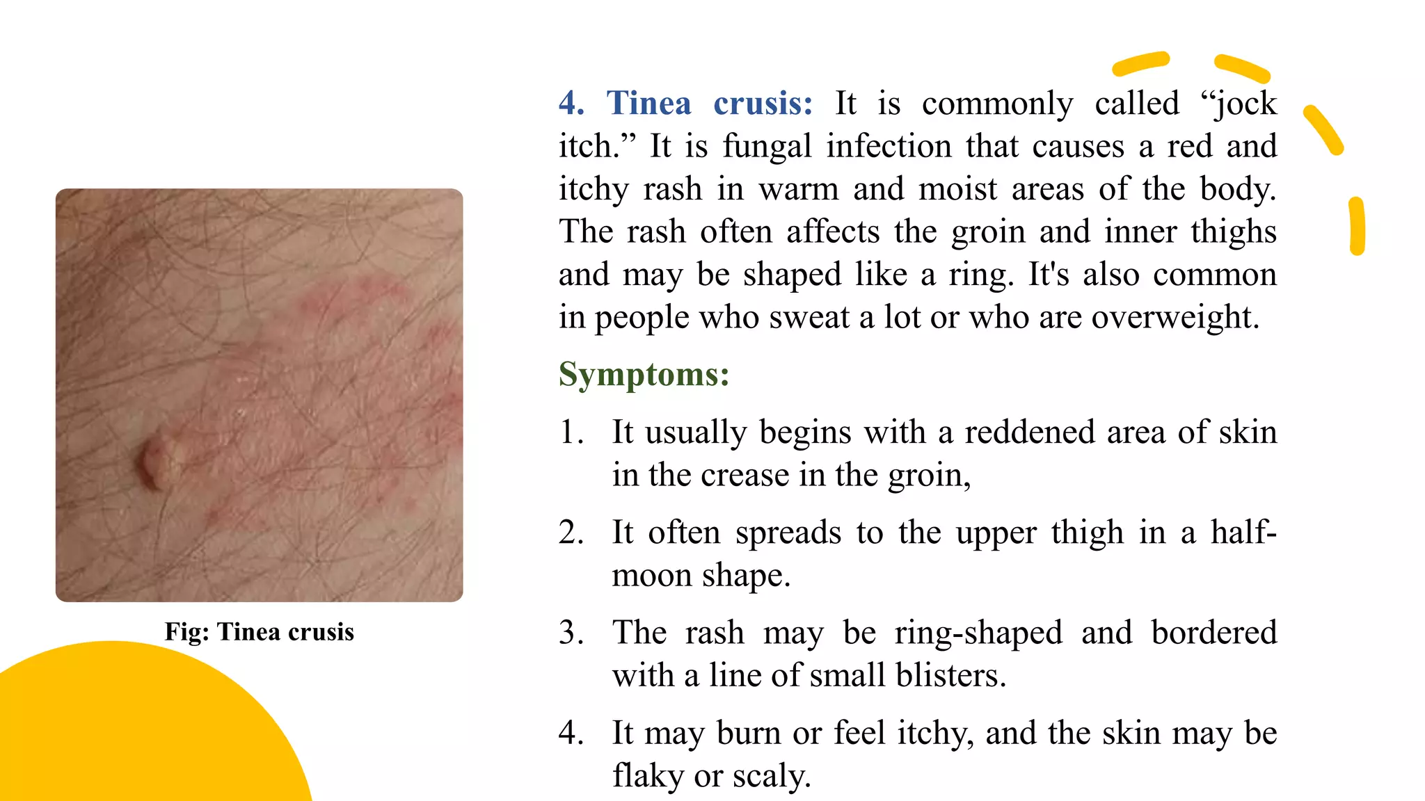 Fungal diseases in humans part 1 | PPTX