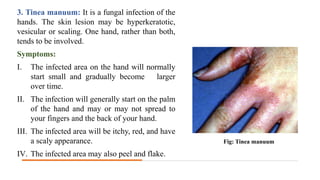 Fungal diseases in humans part 1 | PPTX