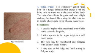 Fungal diseases in humans part 1 | PPTX