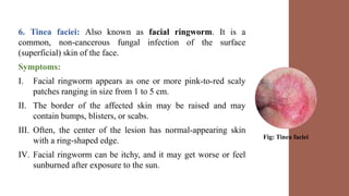 Fungal diseases in humans part 1 | PPTX