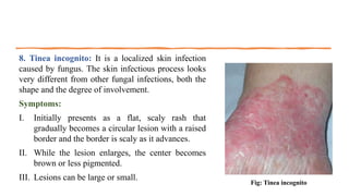 Fungal diseases in humans part 1 | PPTX