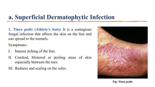 Fungal diseases in humans part 1 | PPTX