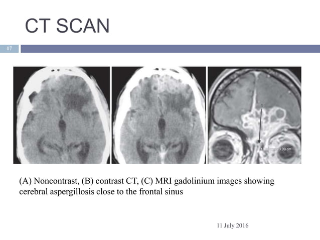 Fungal infection of cns | PPTX