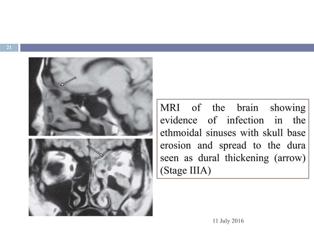 Fungal infection of cns | PPTX