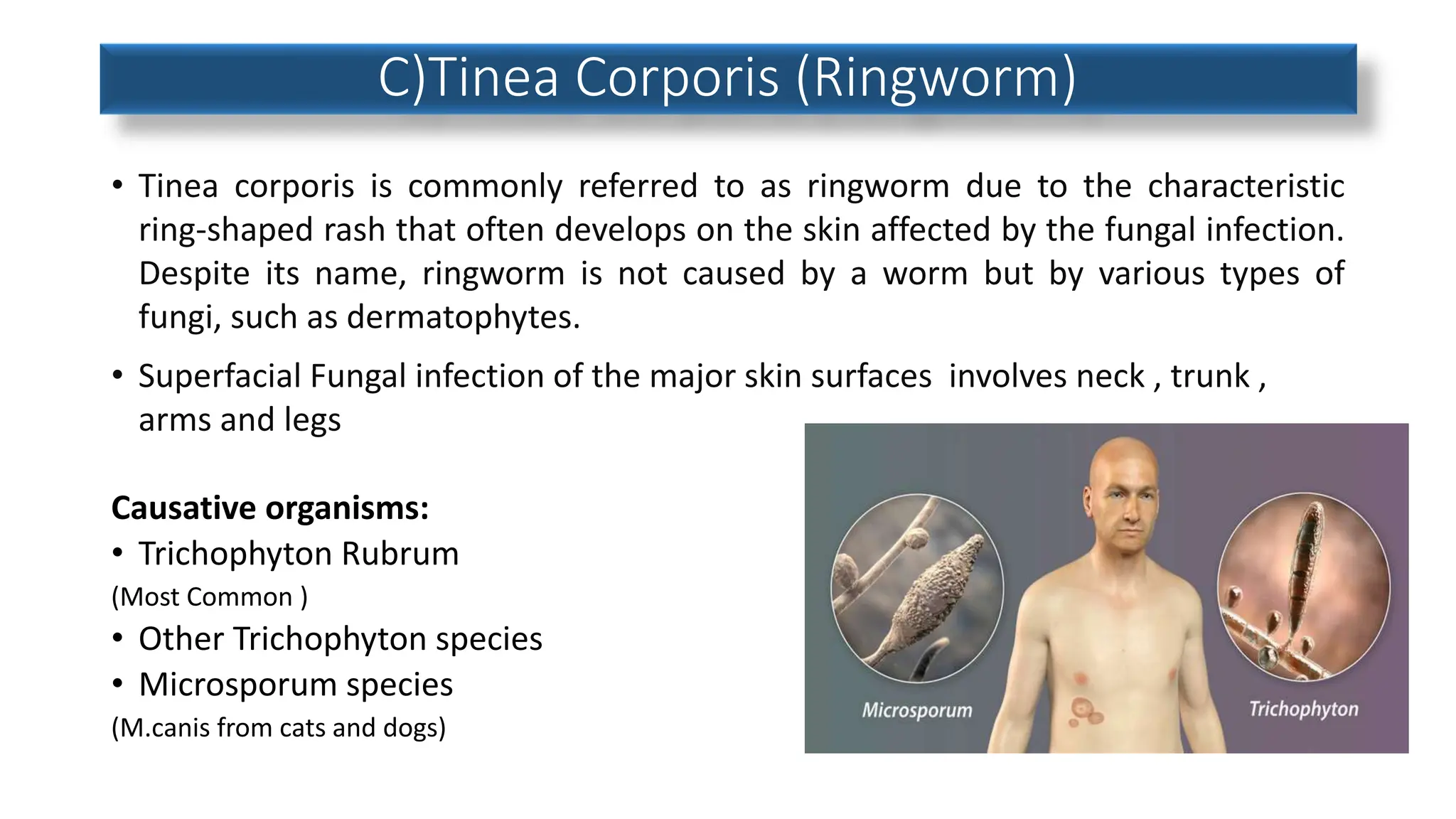 Fungal infection of skin (Dermatophytosis , yeast infection) | PPTX