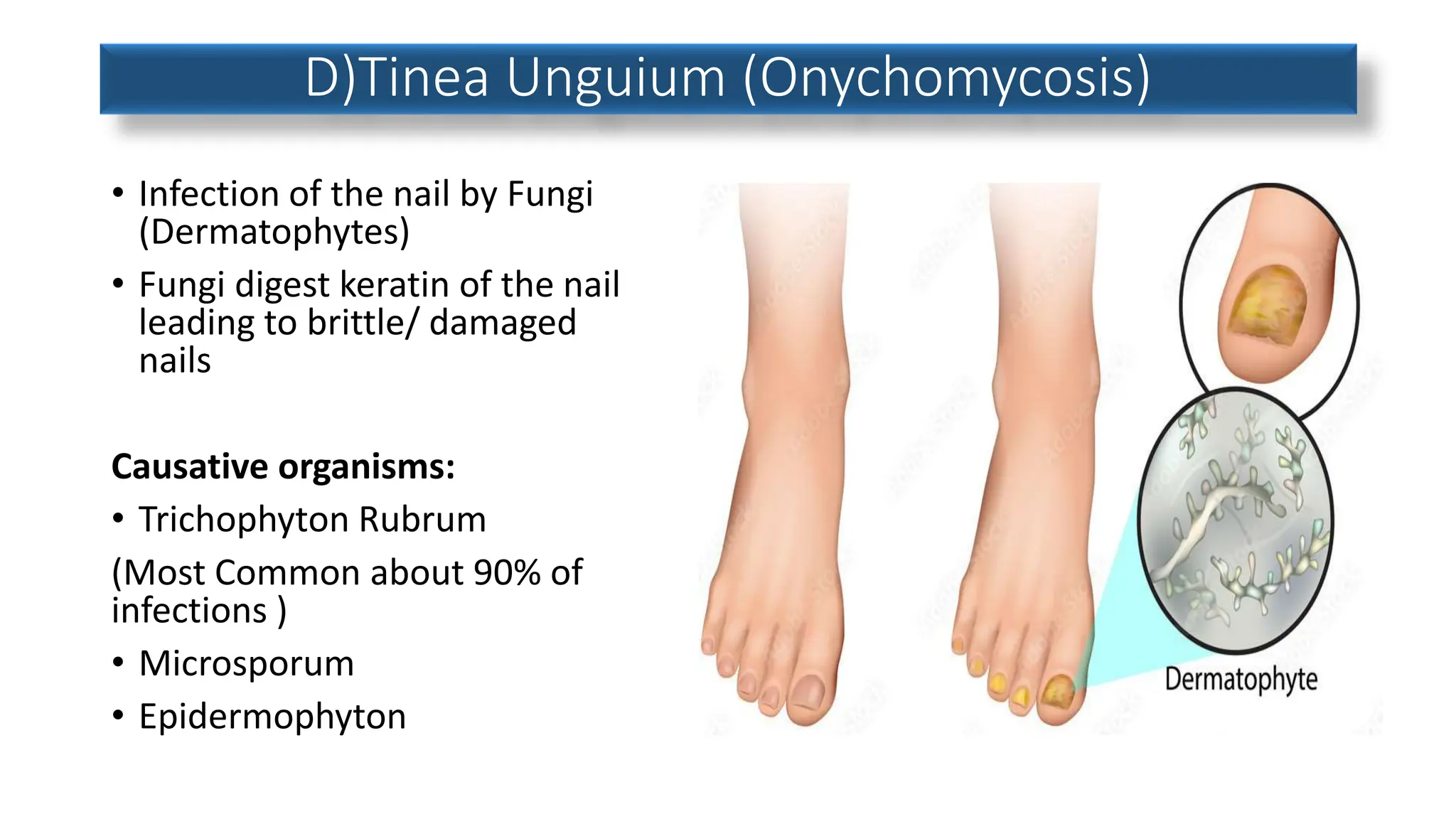 Fungal infection of skin (Dermatophytosis , yeast infection) | PPTX