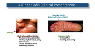 Fungal infection of skin (Dermatophytosis , yeast infection) | PPTX