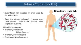 Fungal infection of skin (Dermatophytosis , yeast infection) | PPTX