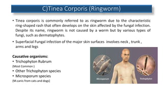 Fungal infection of skin (Dermatophytosis , yeast infection) | PPTX