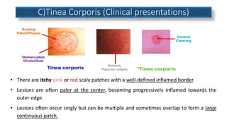 Fungal infection of skin (Dermatophytosis , yeast infection) | PPTX