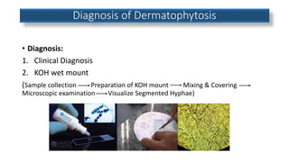 Fungal infection of skin (Dermatophytosis , yeast infection) | PPTX