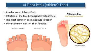 Fungal infection of skin (Dermatophytosis , yeast infection) | PPTX