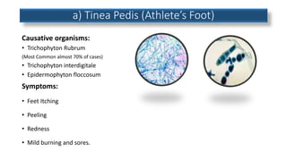 Fungal infection of skin (Dermatophytosis , yeast infection) | PPTX