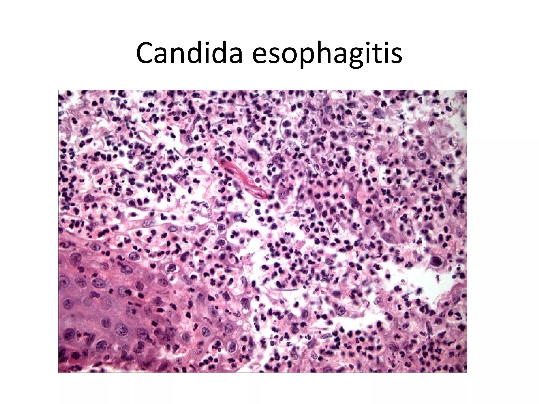 Fungal infections in histopathology | PPT