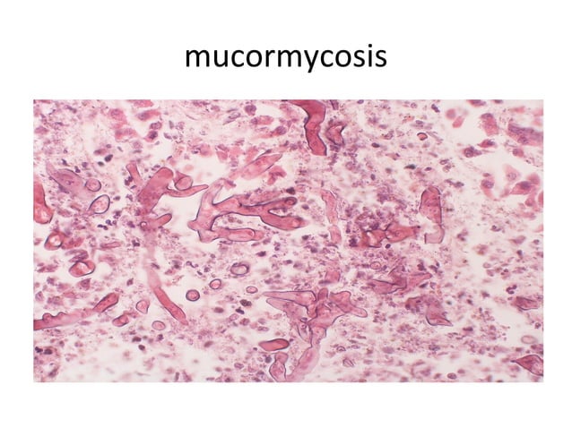 Fungal infections in histopathology | PPT
