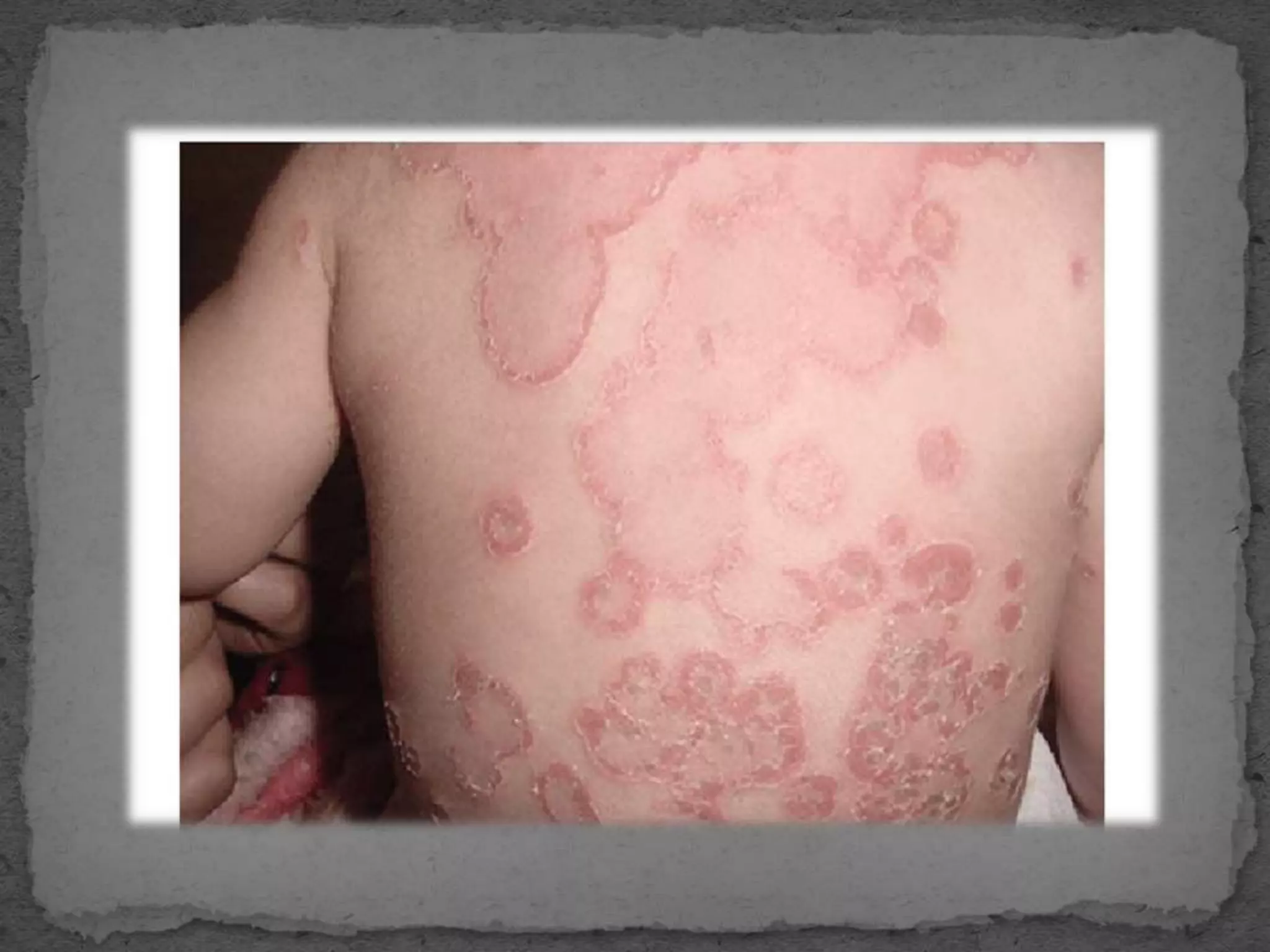 Fungal Infections.pptx