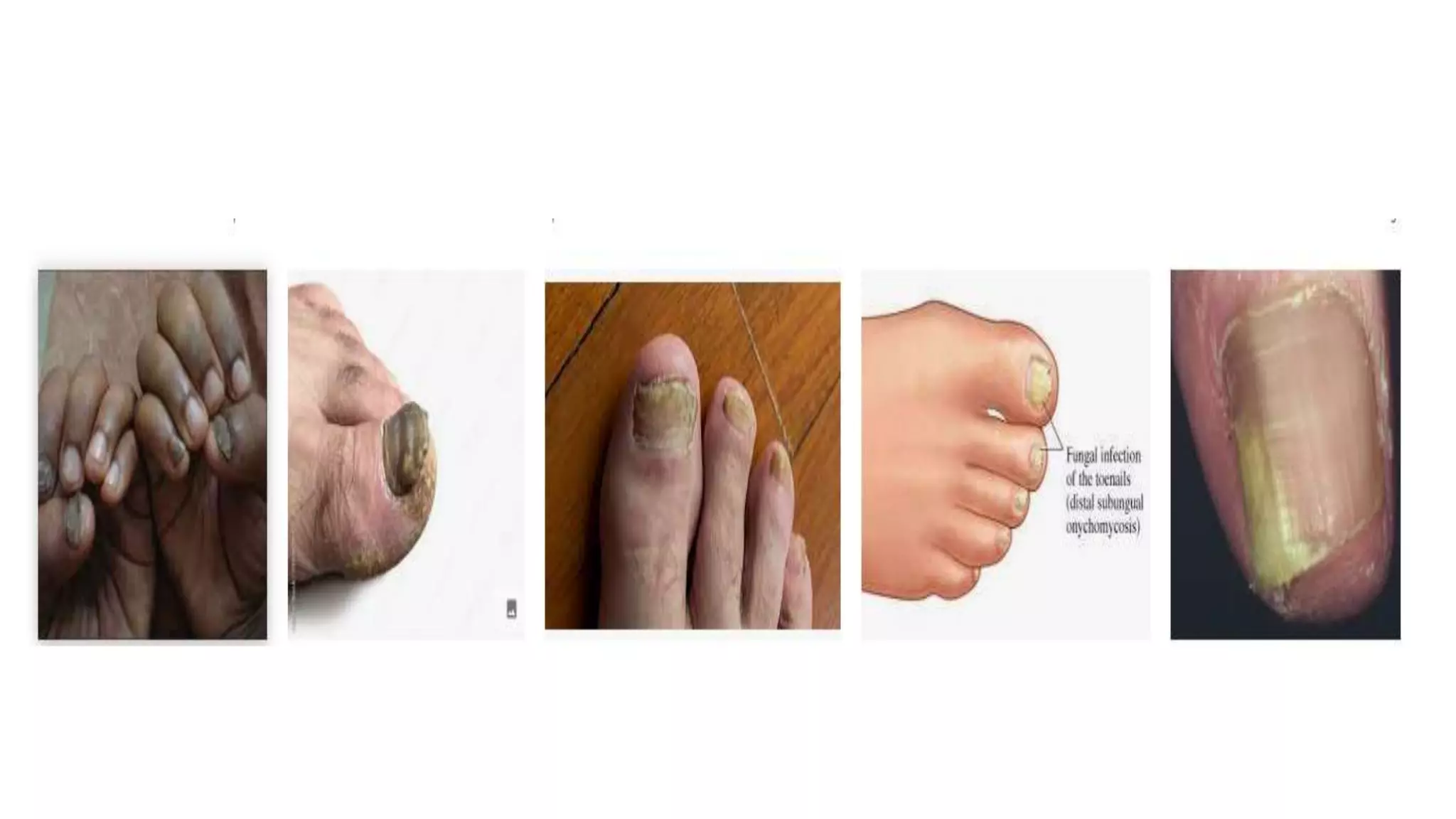 Fungal Infections.pptx