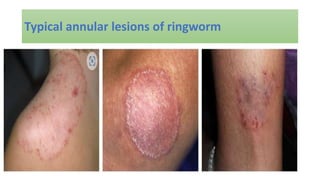Fungal Infections.pptx
