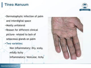 fungal infections for dermatology.pptx.pdf
