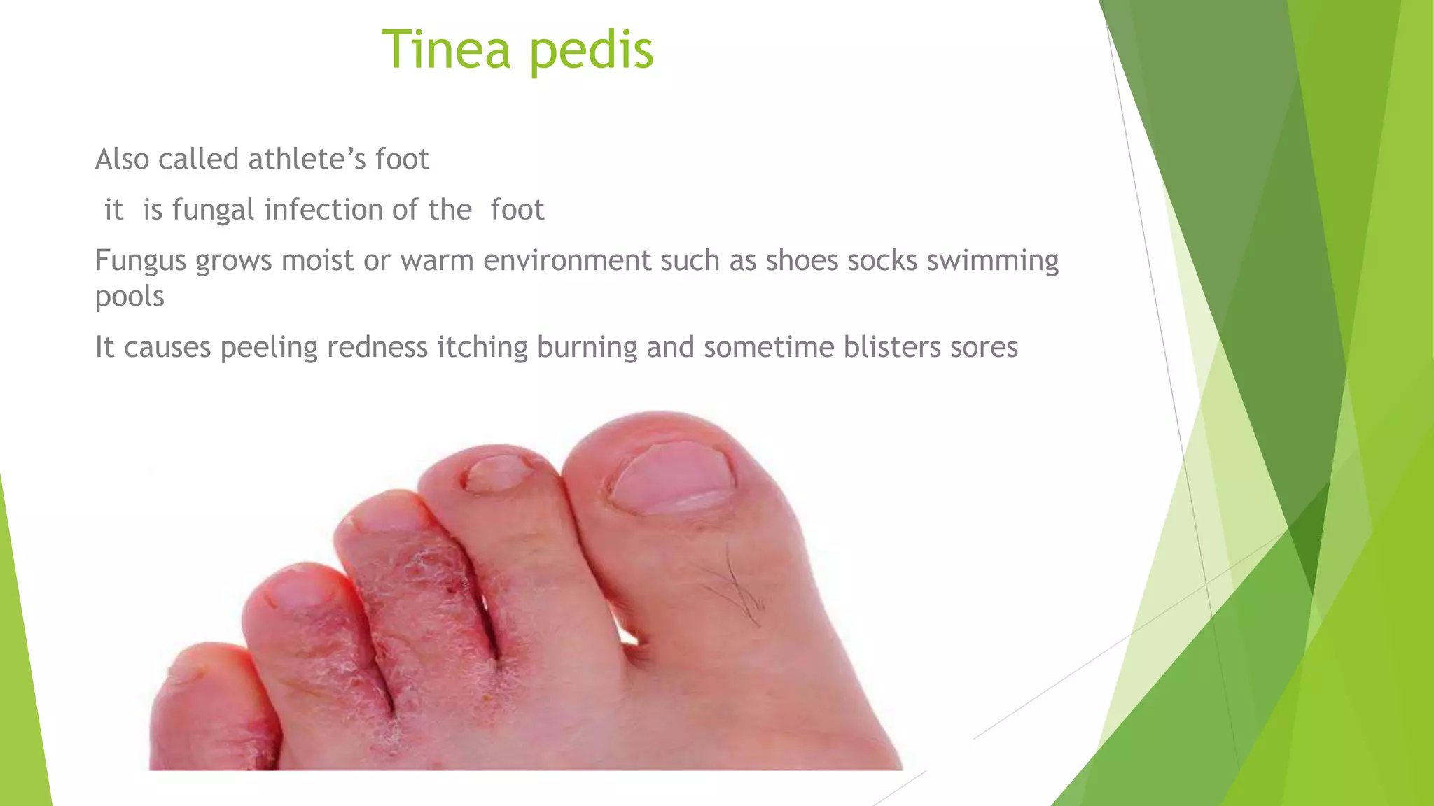 Fungal infections | PPTX