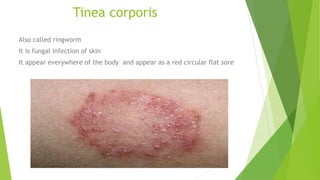 Fungal infections | PPT