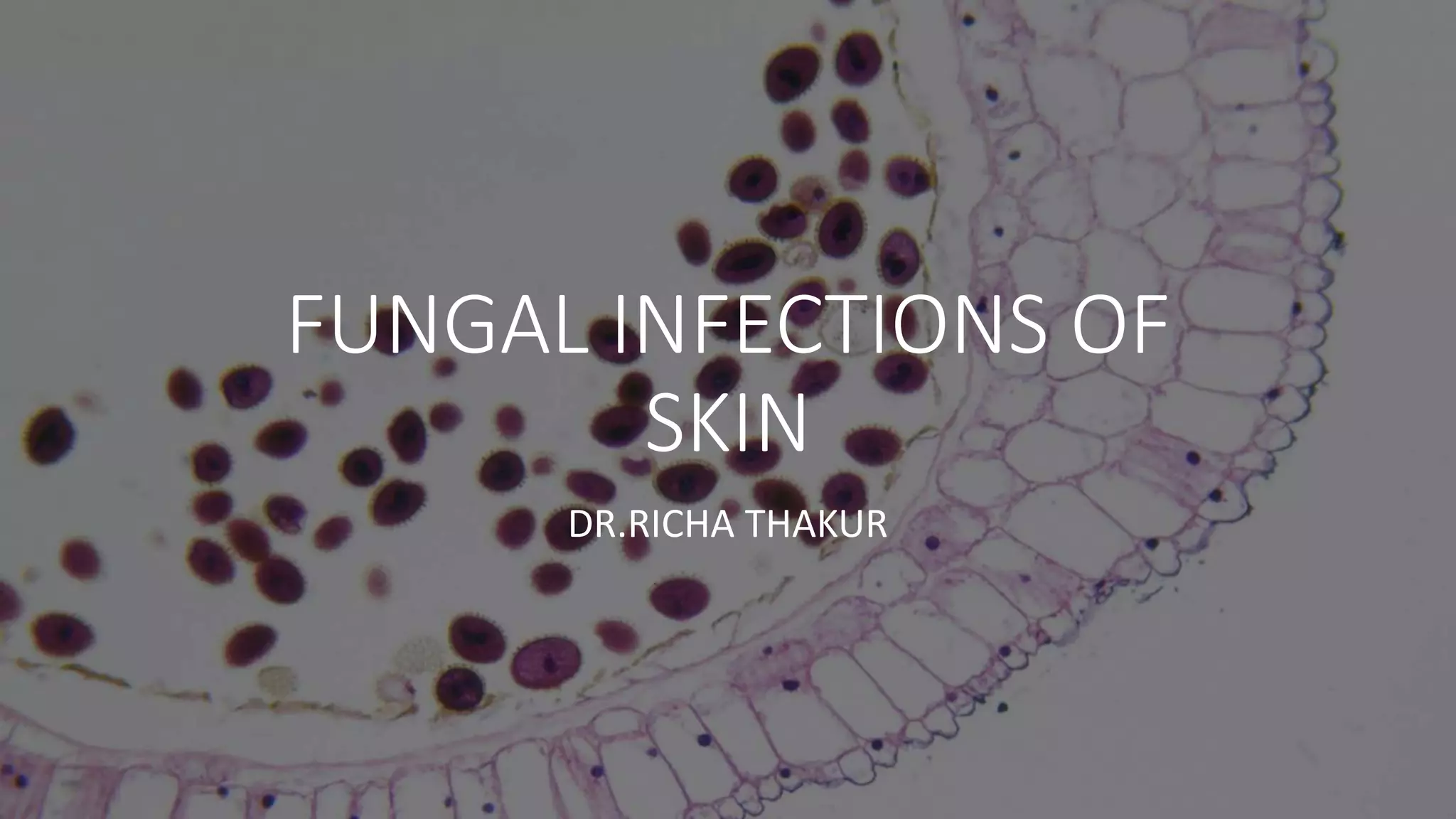 Fungal infections of skin | PPT