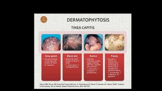 Fungal infections of skin | PPT