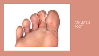 Fungal infections of skin | PPT