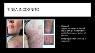 Fungal infections of skin | PPT