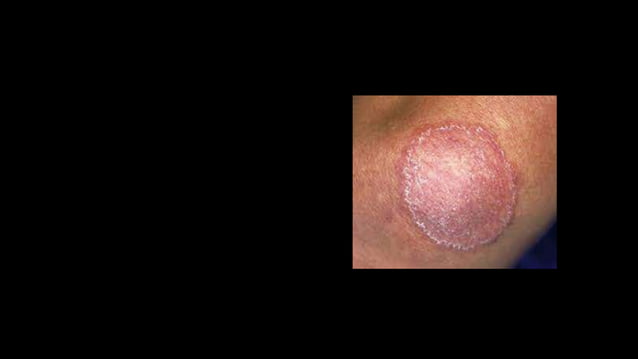 Fungal infections of skin | PPT