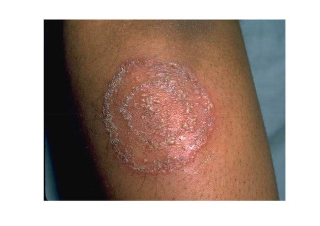 Fungal infections of skin [compatibility mode] | PPT
