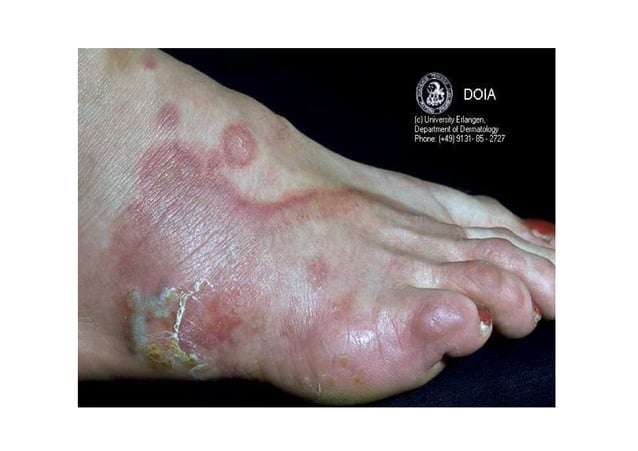 Fungal infections of skin [compatibility mode] | PPT