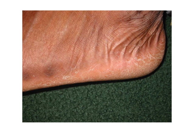 Fungal infections of skin [compatibility mode] | PPT