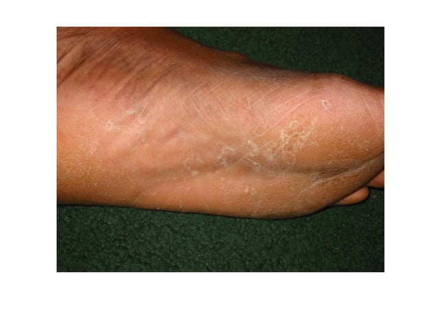 Fungal infections of skin [compatibility mode] | PPT