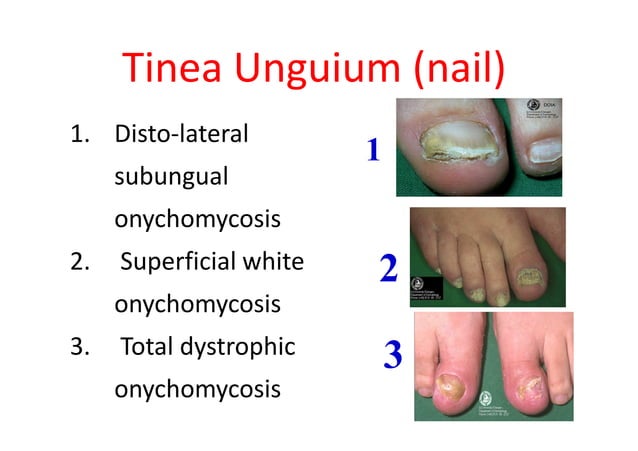 Fungal infections of skin [compatibility mode] | PPT