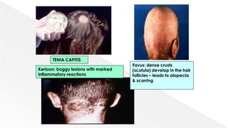 Fungal Infections of Skin, Soft tissue.pptx