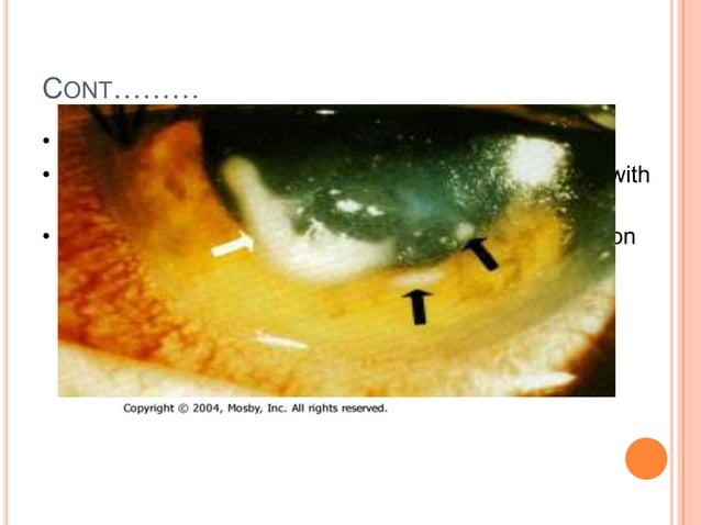 Fungal infections of the eye | PPTX | Eye and Vision Conditions ...