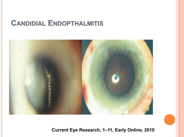 Fungal infections of the eye | PPTX | Eye and Vision Conditions ...