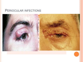 Fungal infections of the eye | PPTX