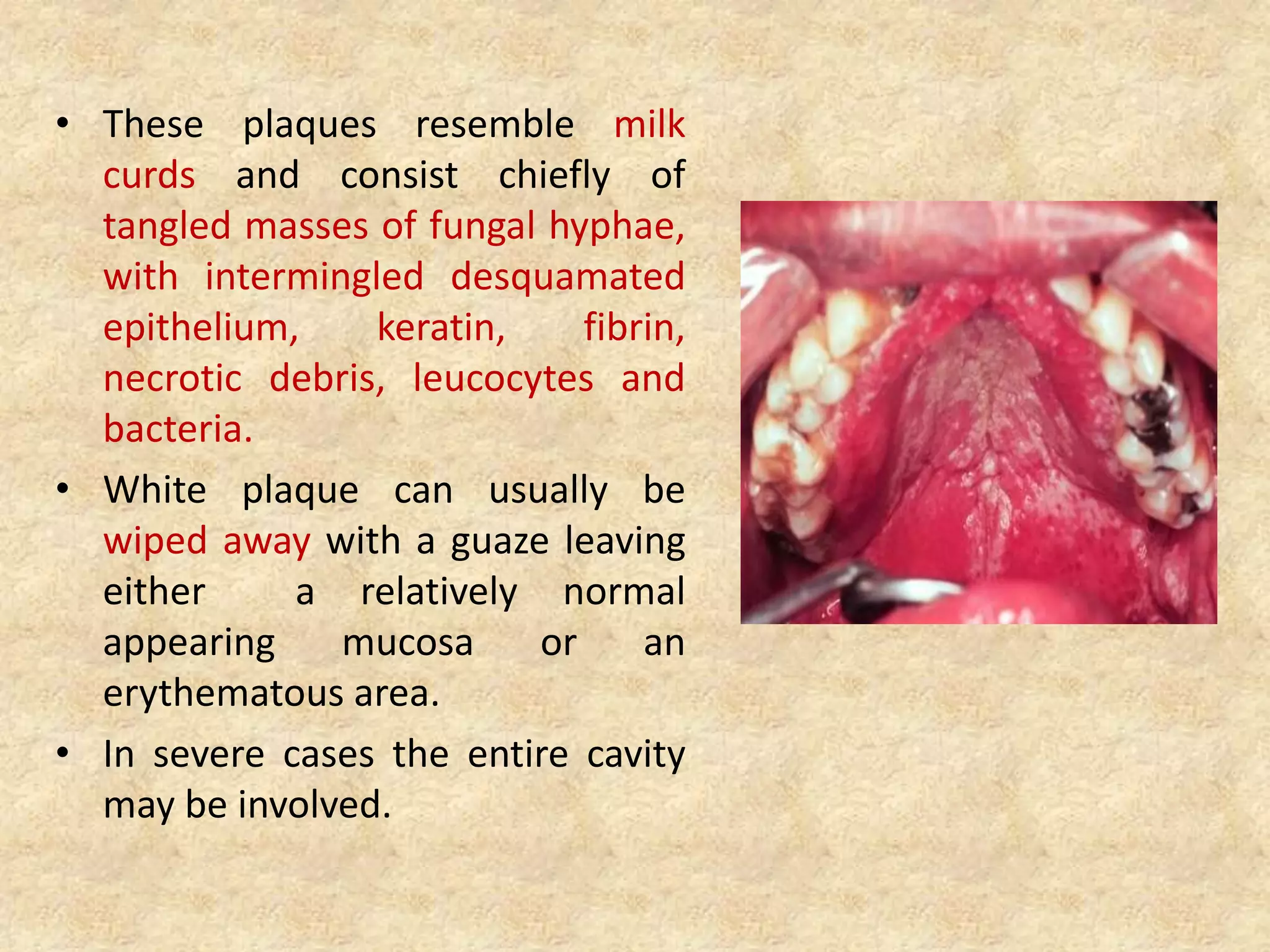 Fungal infections of the oral cavity | PPTX
