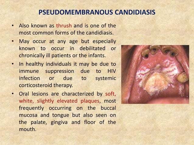 Fungal infections of the oral cavity | PPTX | Dental Health | Diseases ...