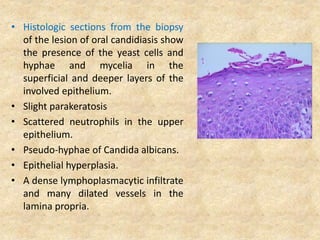 Oral Candidiasis Histology