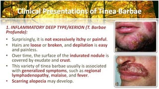 Tinea Barbae