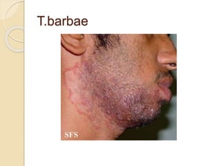 Fungal Infections/ Mycoses ppt by Dr.C.P.PRINCE | PPTX
