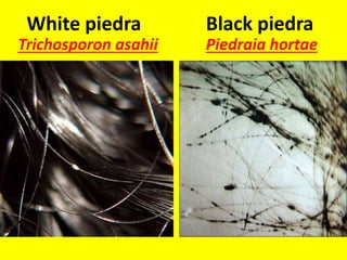 Fungal infections prenav | PPTX