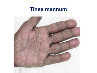 Fungal infections prenav | PPTX